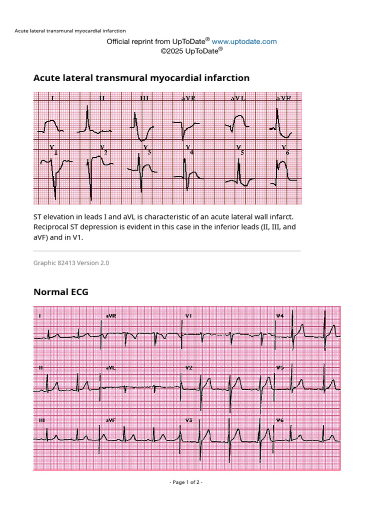 Acute Lateral Transmural Myocardial Infarction | PDF