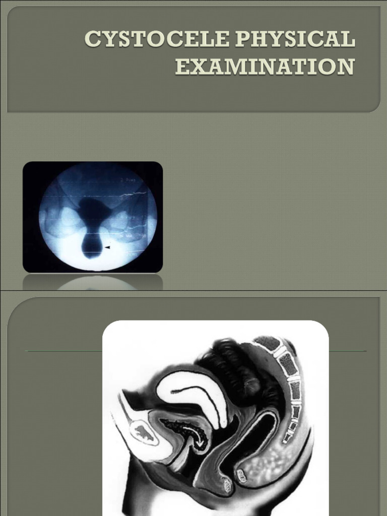 Examining Cystocele Grades and Diagnosis | PDF | Vagina | Urology