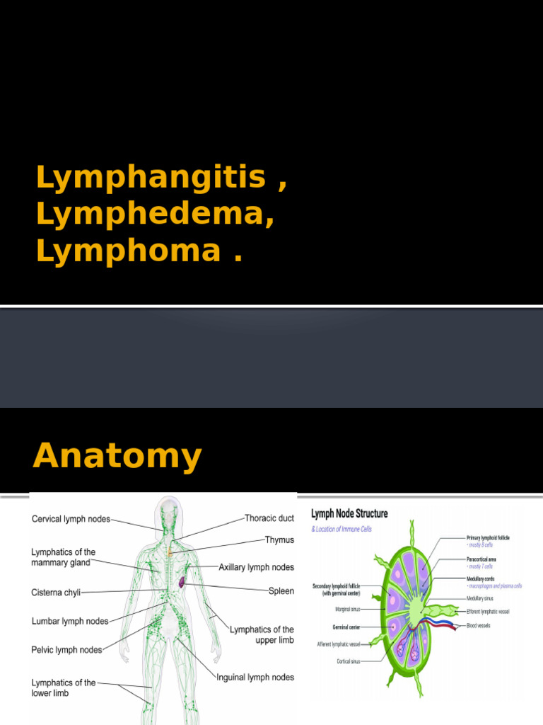 Lymphangitis Lymphedema LYMPHOMA | PDF | Lymphoma | Lymphocyte