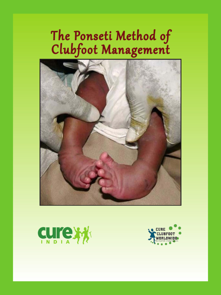 Ponseti Method for Clubfoot Treatment Guide | PDF | Anatomical Terms Of ...