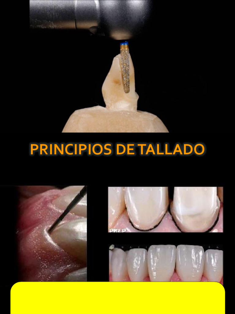Principios del Tallado Dental | PDF