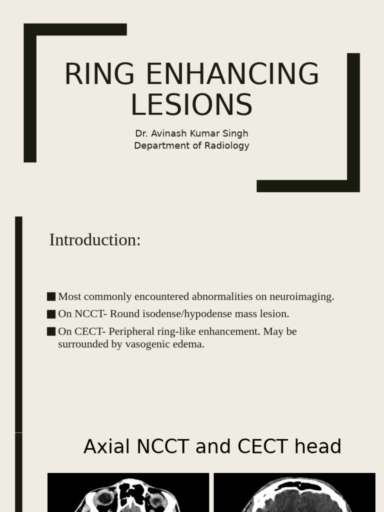 Ring Enhancing Lesions (1) (Read-Only) DR Avi | PDF | Cerebrospinal ...