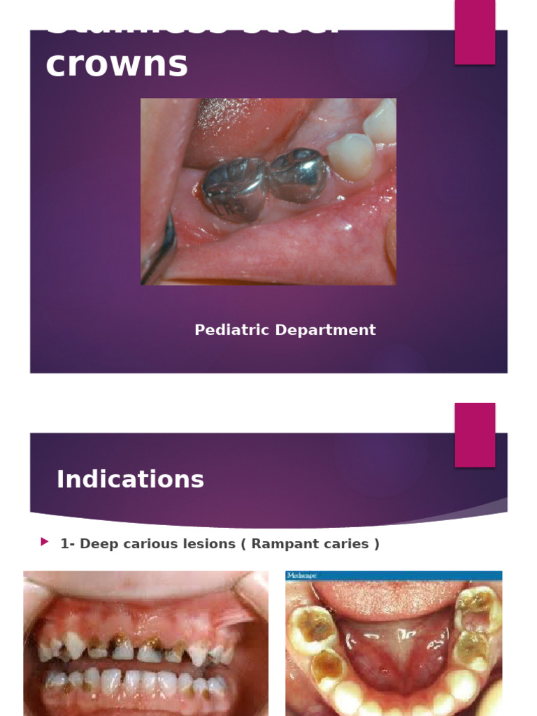Stainless Steel Crowns | PDF