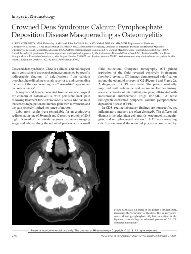 Crowned Dens Syndrome Case Report | PDF | Diseases And Disorders ...