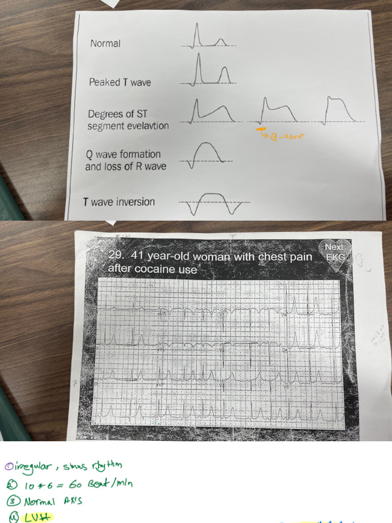 ECG Papers - Dr. Mohammed Nassr | PDF | Heart | Cardiovascular Physiology