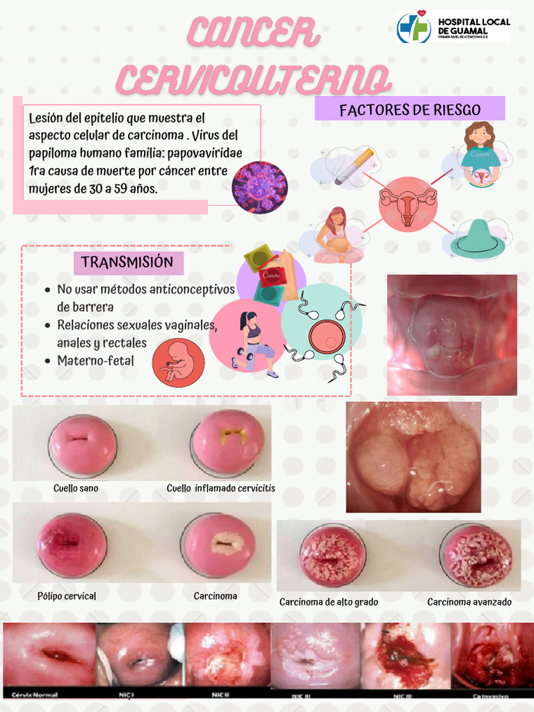 Cancer Cervicouterino | PDF