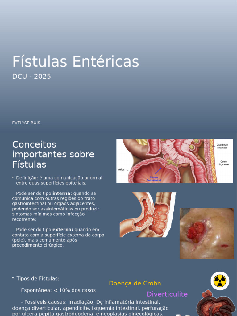 Fistulas Entericas | PDF | Sepse | Colite ulcerosa