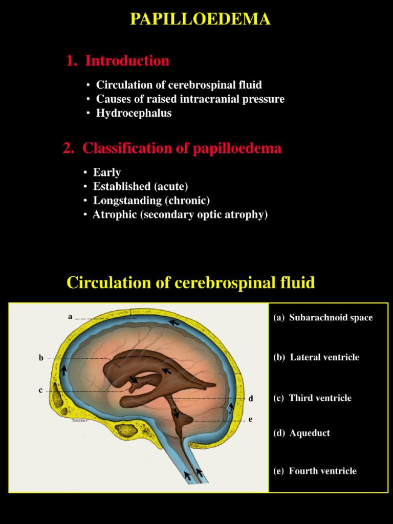 Papilledema Pdf