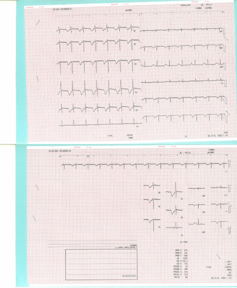 EKG Contoh Hasil | PDF
