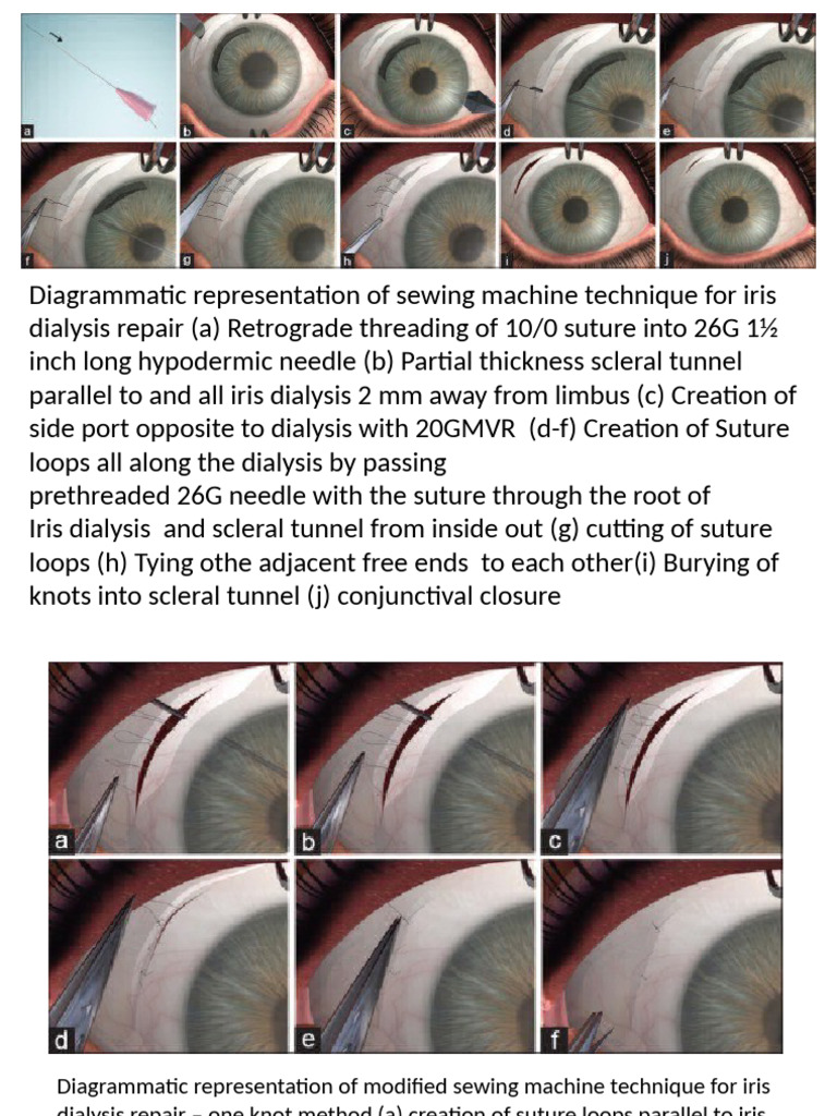 Iris Dialysis Repair Techniques Illustrated | PDF