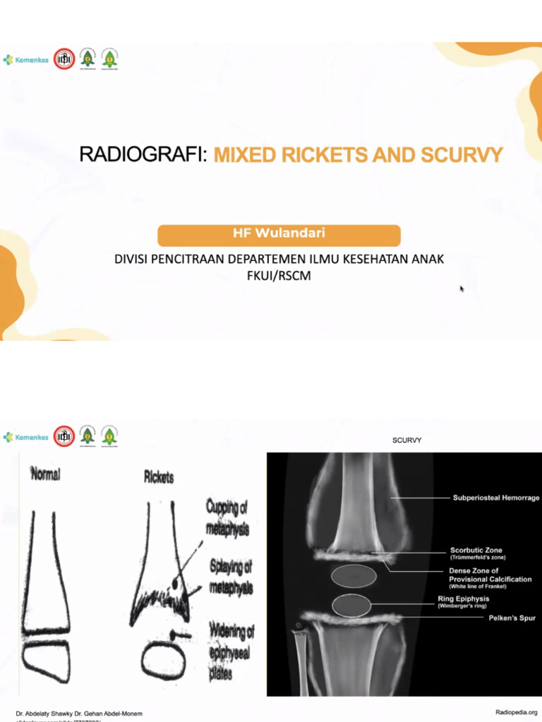 Radiografi - Mixed Rickets and Scurvy | PDF