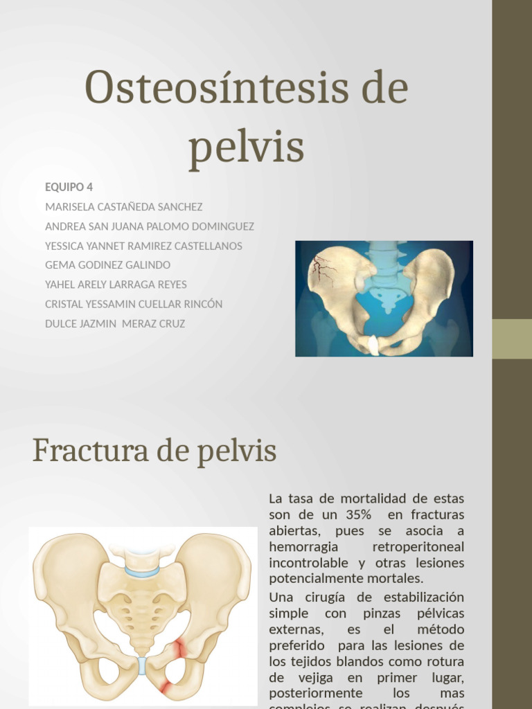 Osteosintesis de Pelvis Eq 4 | PDF | Pelvis | Tornillo