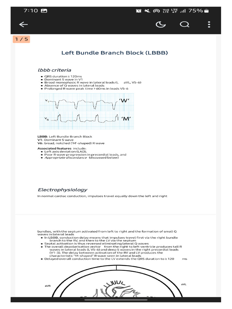 LBBB RBBB | PDF