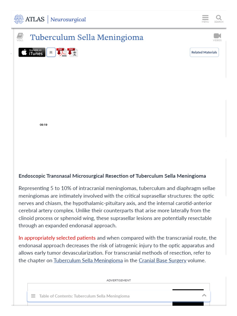 Tuberculum Sella Meningioma FDGFGXGFGXFGXFGXFG | PDF | Surgery | Brain ...