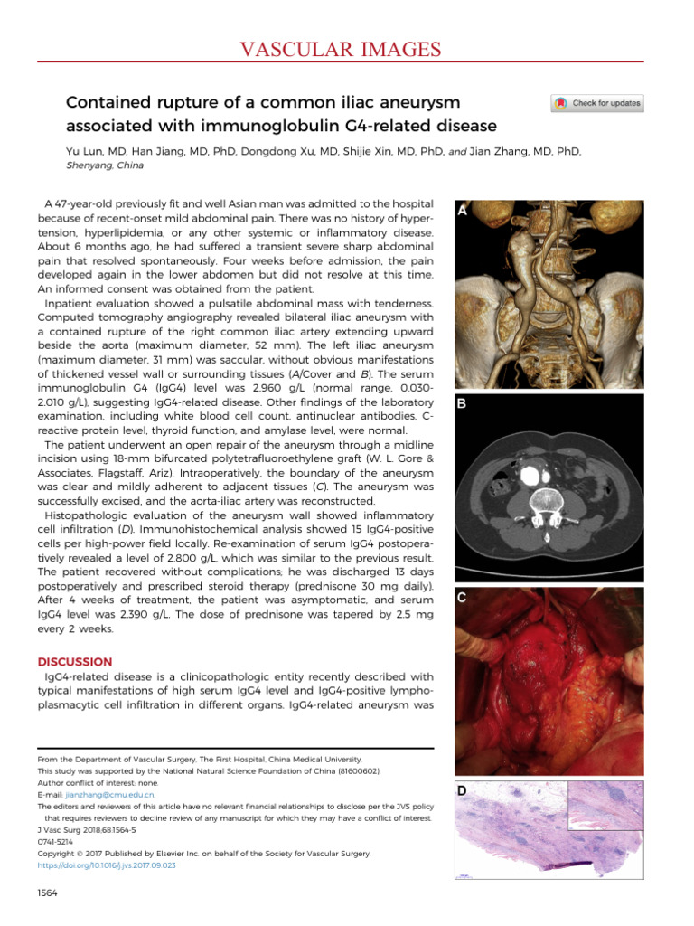 Contained Rupture of A Common Iliac Aneurysm Associated 2018 Journal of ...
