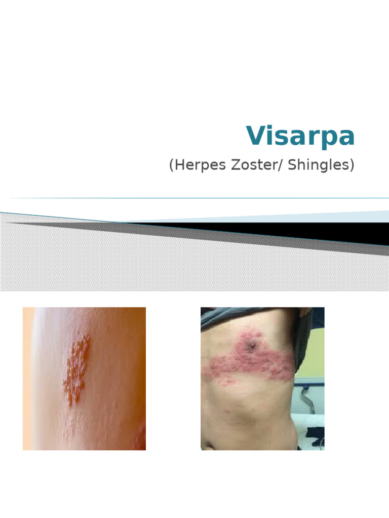 Visarpa Chikitsa Overview and Remedies | PDF