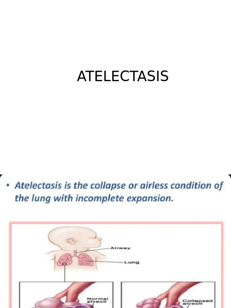 Atelectasis | PDF
