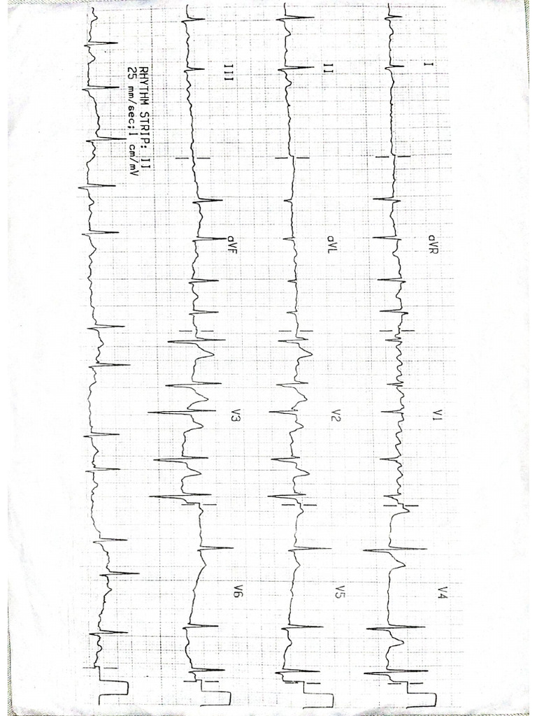 Medicine Charts of Ecg | PDF