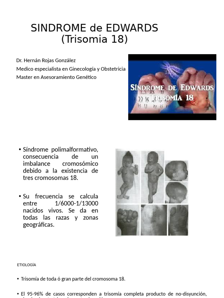 SINDROME de EDWARDS (Trisomia 18) | PDF | Defecto cardiaco congenito ...