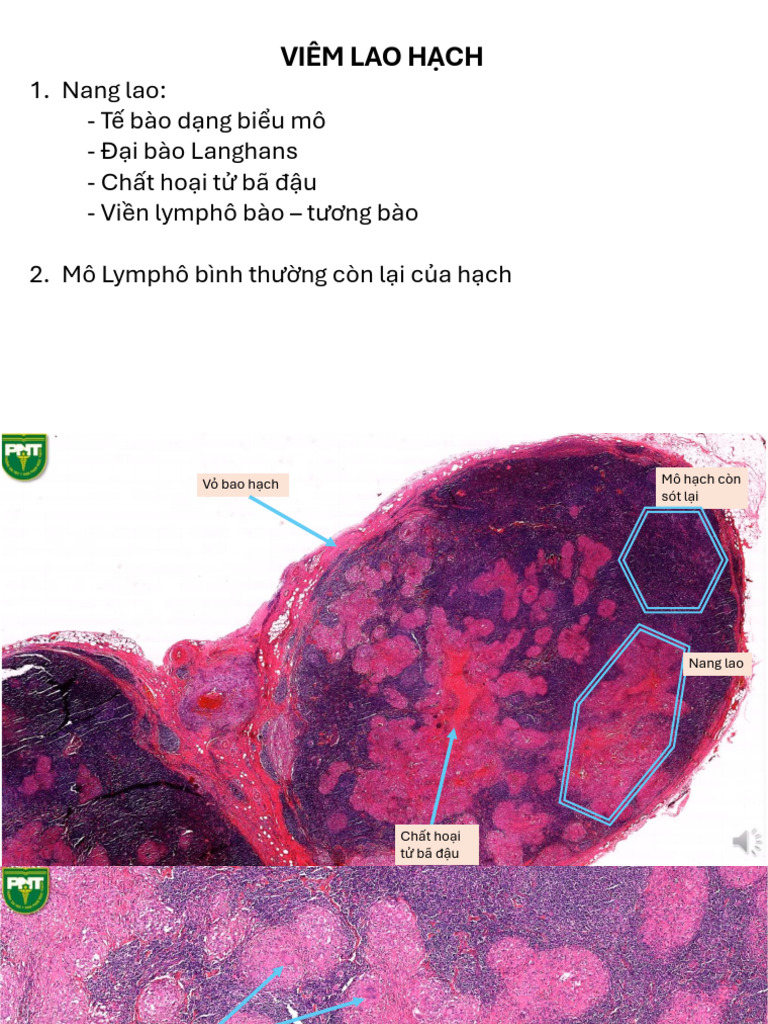 Viêm Lao H CH | PDF