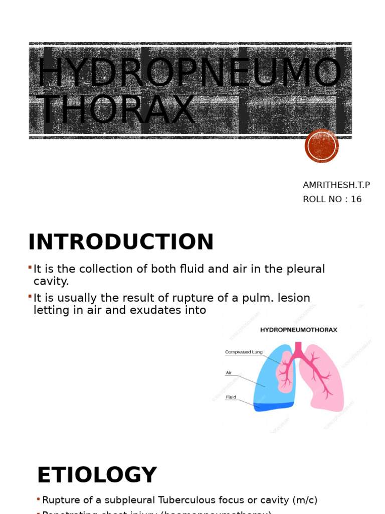 Causes and Management of Hydropneumothorax | PDF
