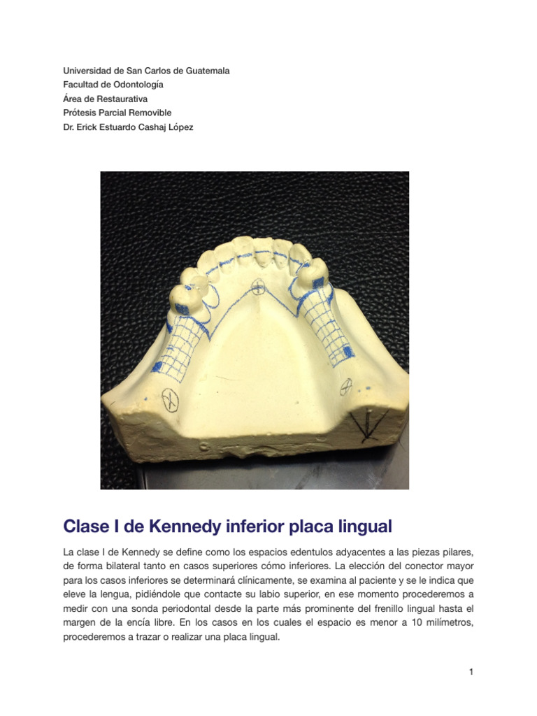 Diseño de Placa Lingual Clase I Kennedy | PDF