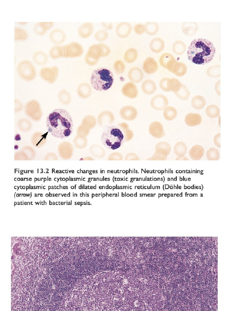 WBC Disorders | PDF