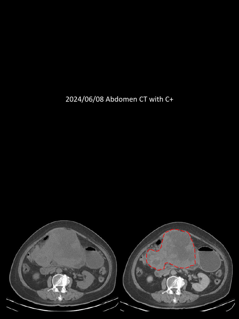 2024 Abdomen CT & MRCP Tumor Analysis | PDF