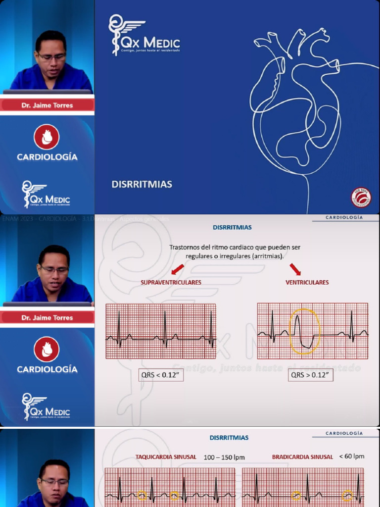 Cardiologia - Disrritmias | PDF