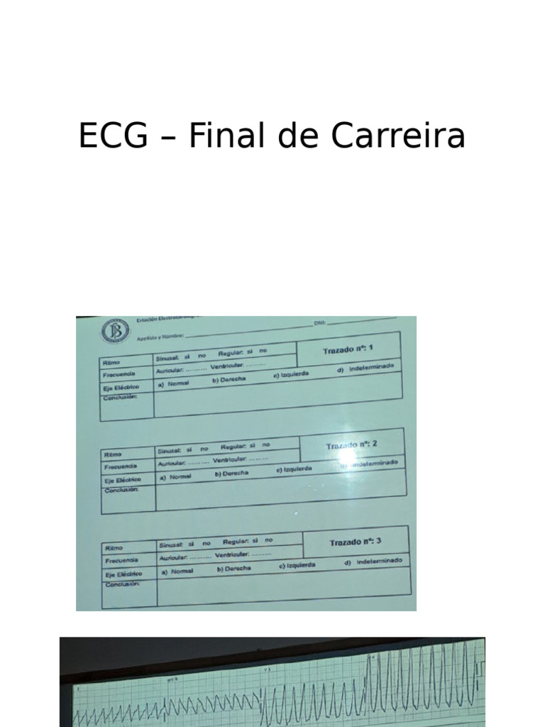 ECG - Final de Carreira | PDF | Electrofisiologia | Enfermedades ...