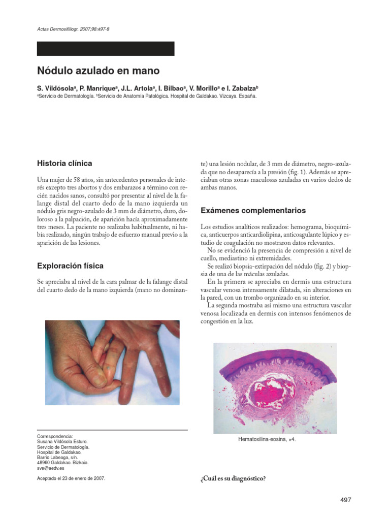 Nódulo Azulado en Mano: Casos para El Diagnóstico | PDF | Trombo | Mano
