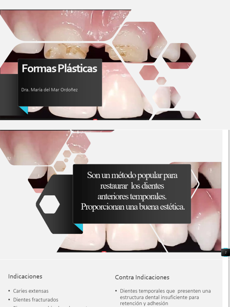 Coronas de Resina Compuesta en Odontopediatría | PDF | Especialidades ...