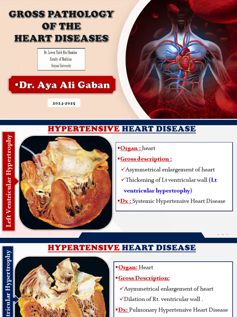 Gross Patho of Heart Dis 2025 (Practical & Oral) | PDF | Cardiac Muscle ...