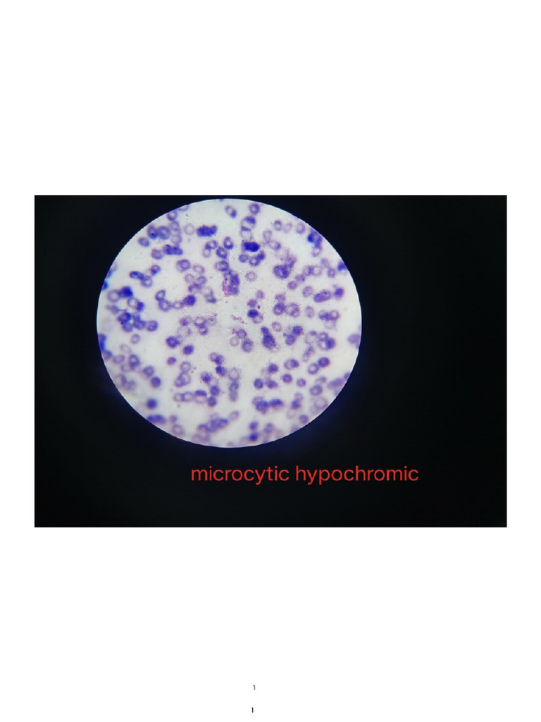 Pathology Practical (Anemia) 3 | PDF