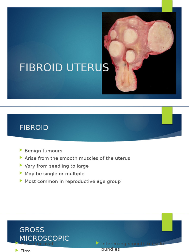 Fibroid Uterus | PDF