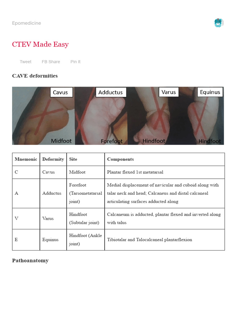 CTEV Made Easy - Epomedicine | PDF | Foot | Ankle