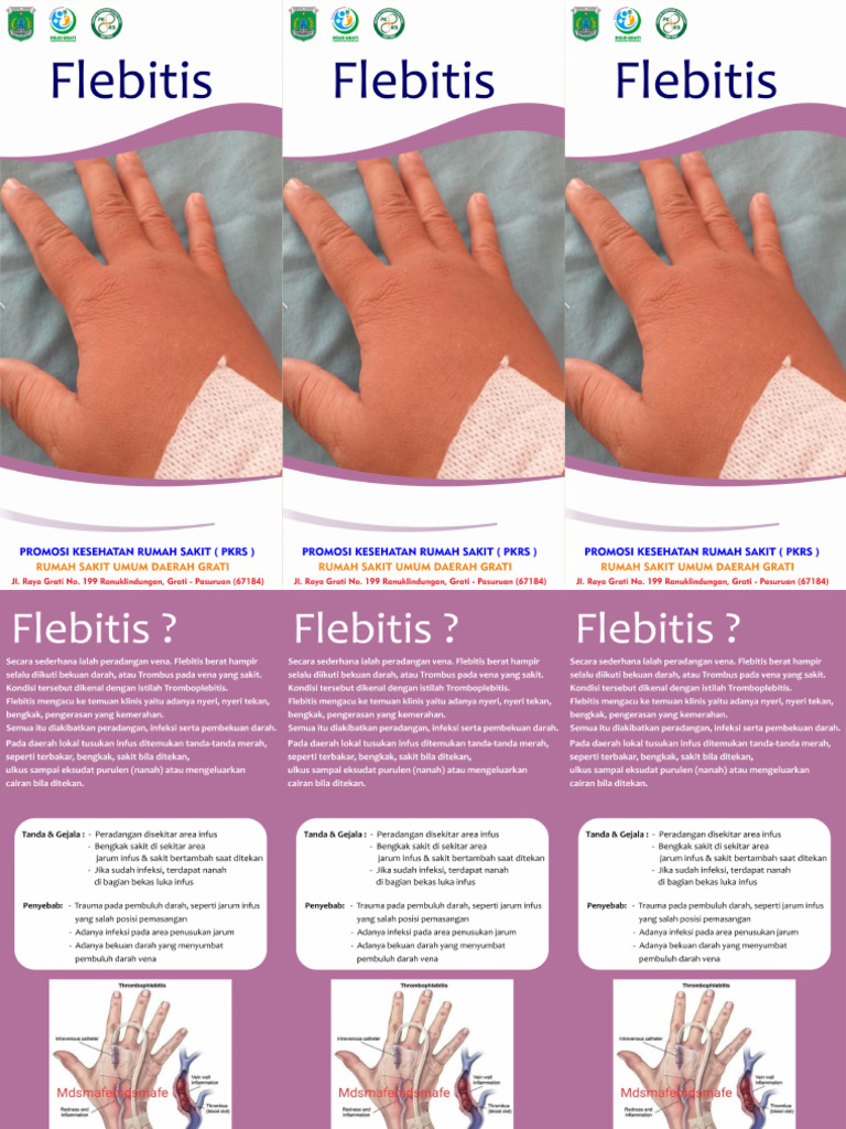 FLEBITIS | PDF