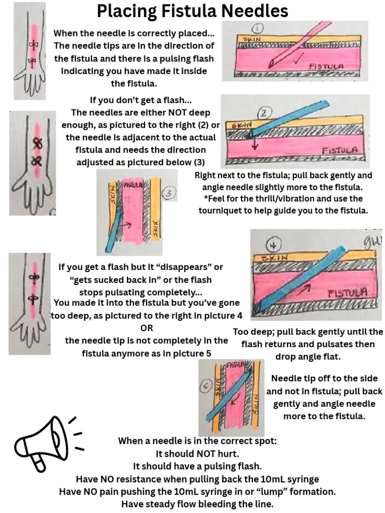 Fistula Needle Placement Guide | PDF | Artery | Syringe