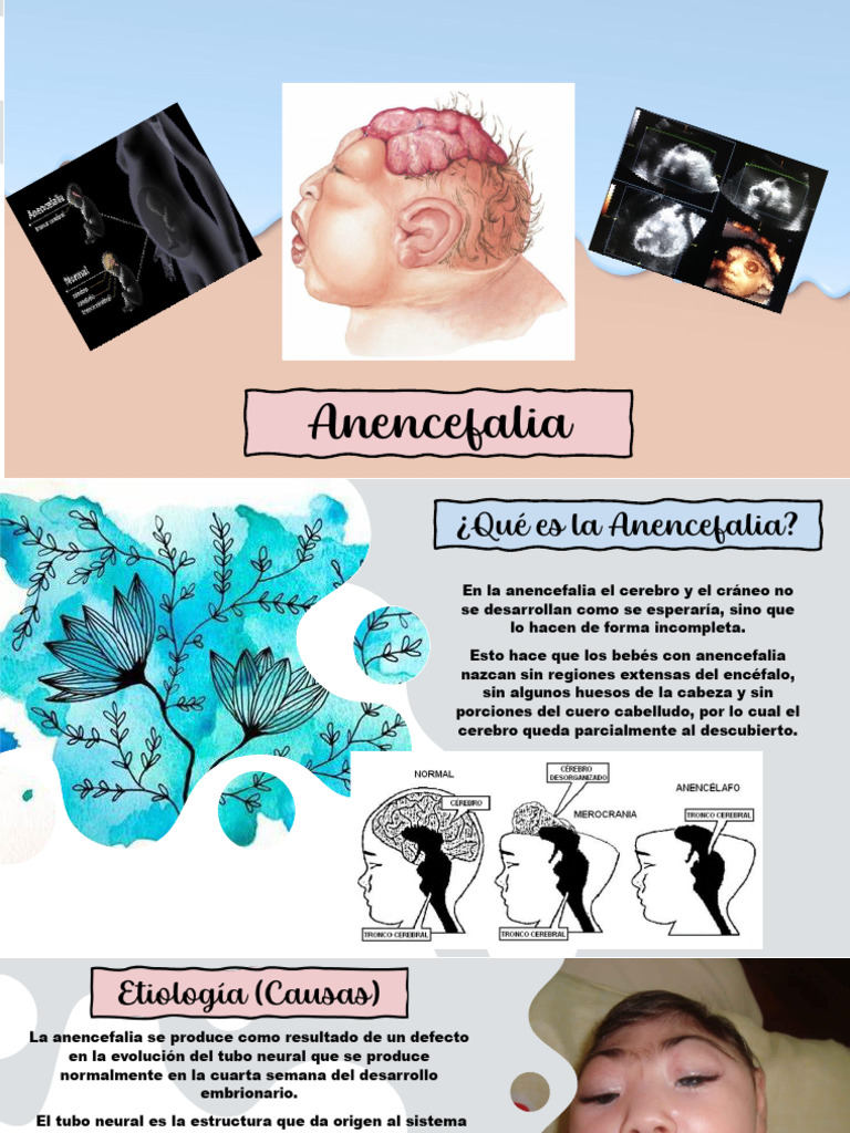 Anencefalia Microcefalia | PDF | El embarazo | Enfermedades y trastornos humanos