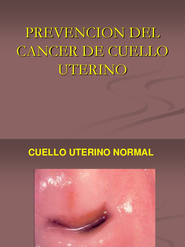 CA de Cuello Uterino | Cáncer de cuello uterino | Cáncer