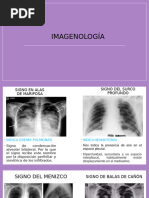 Signo del Anillo de Sello en TC | PDF | Respiración | Anatomia animal