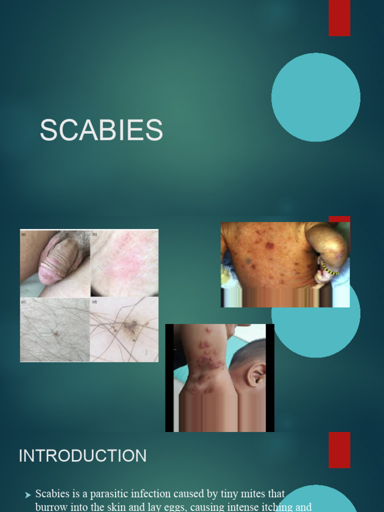 Understanding Scabies: Symptoms & Treatment | PDF | Diseases And ...