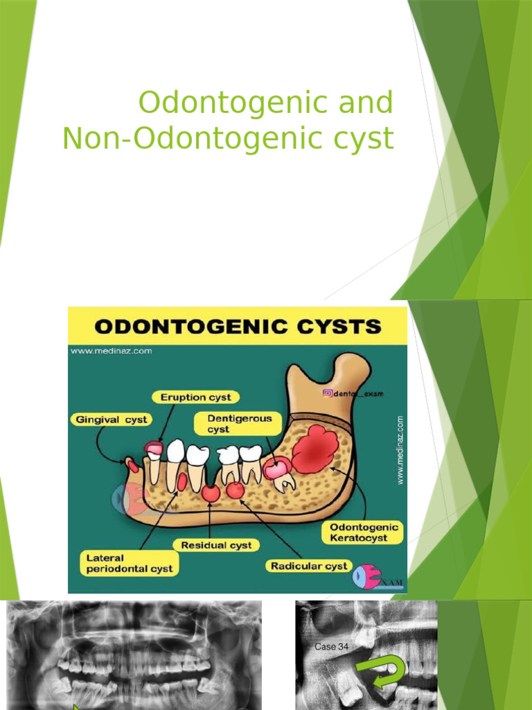 Odontogenic and Non Odontogenic Cyst | PDF | Epithelium