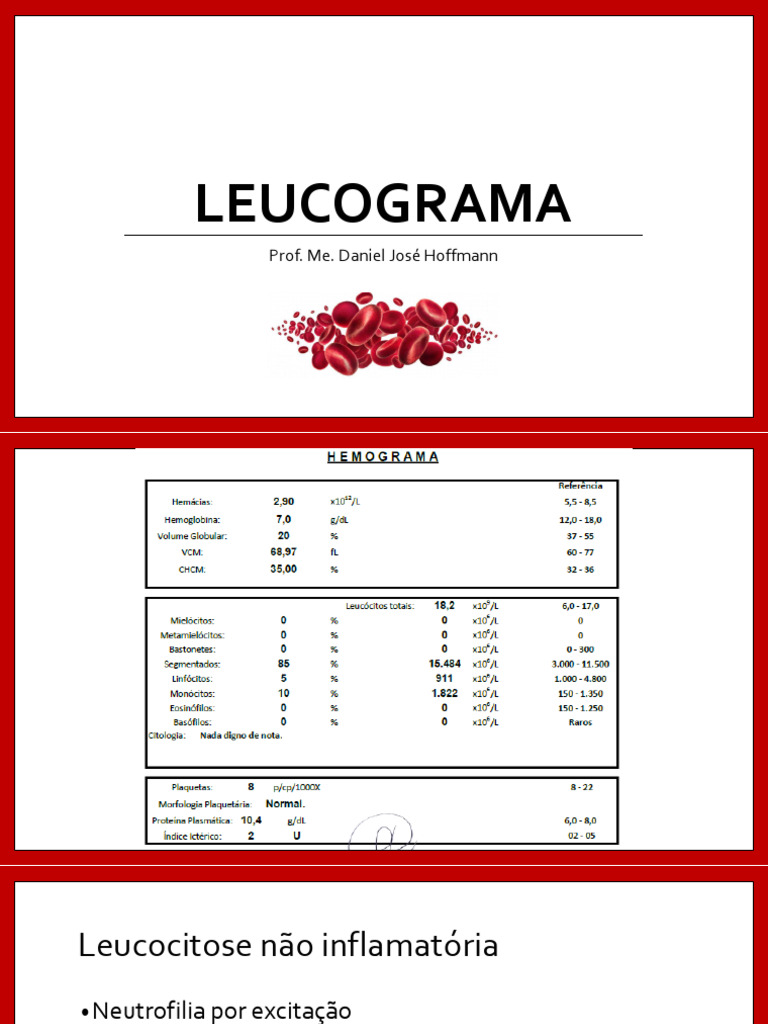 LEUCOGRAMA - 5 | PDF | Leucemia | Linfócito