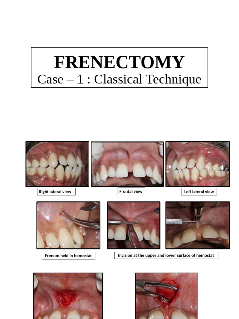 Miller's Frenectomy Techniques Overview | PDF