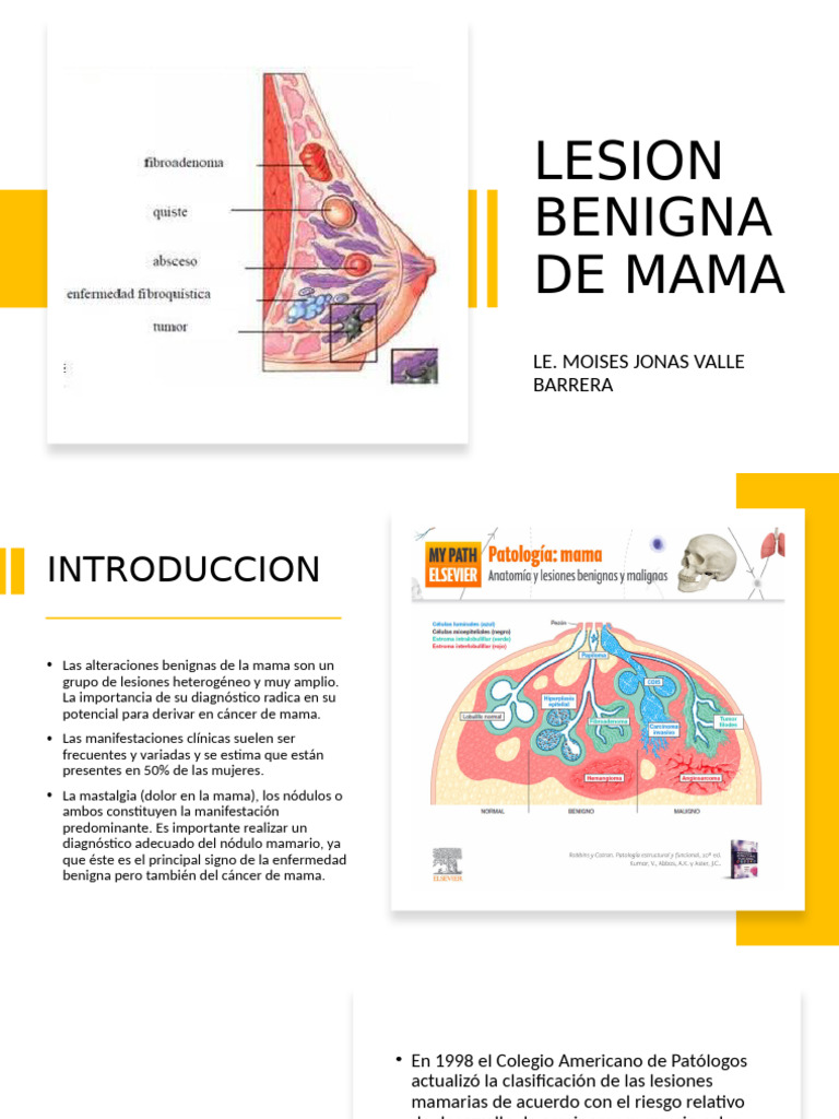 Lesion Benigna de Mama | PDF | Pecho | Cáncer de mama