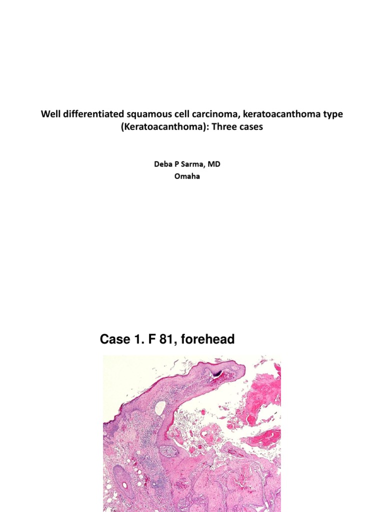 Well Differentiated Squamous Cell Carcinoma, Keratoacanthoma Type ...