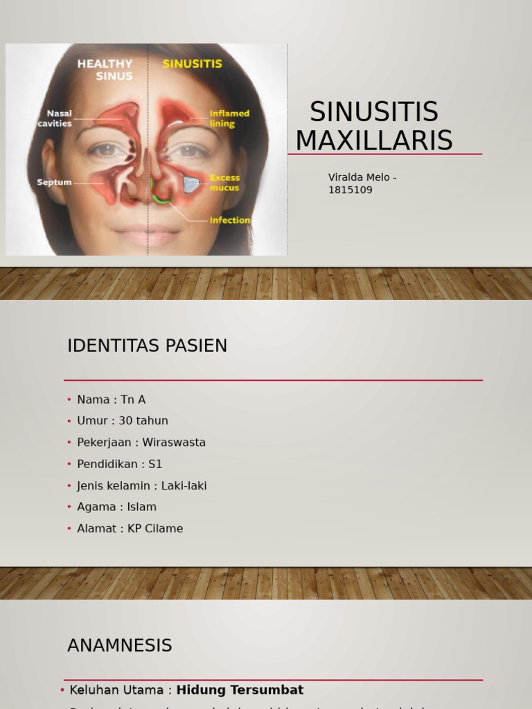Sinusistis Maksilaris | PDF
