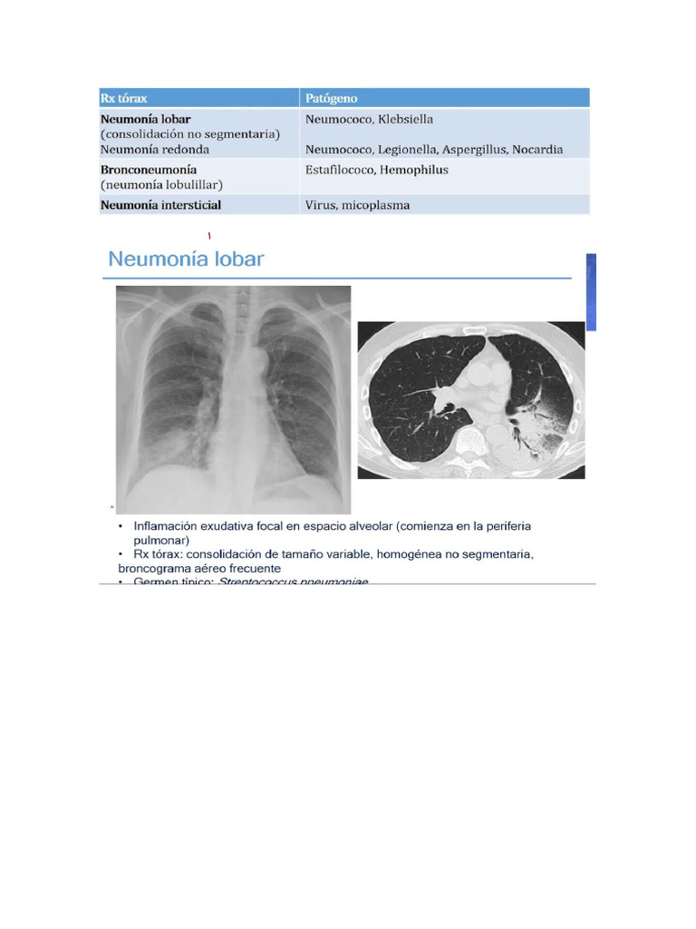 Neumonía Pdf