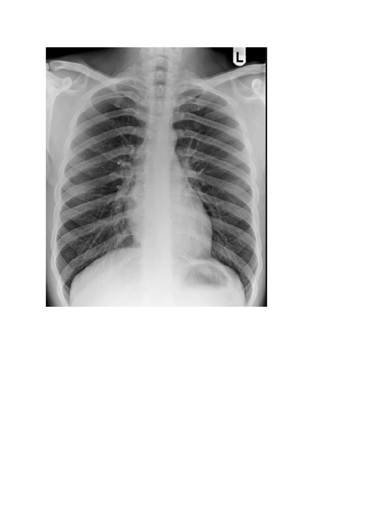 Normal Chest X-Ray Interpretation | PDF